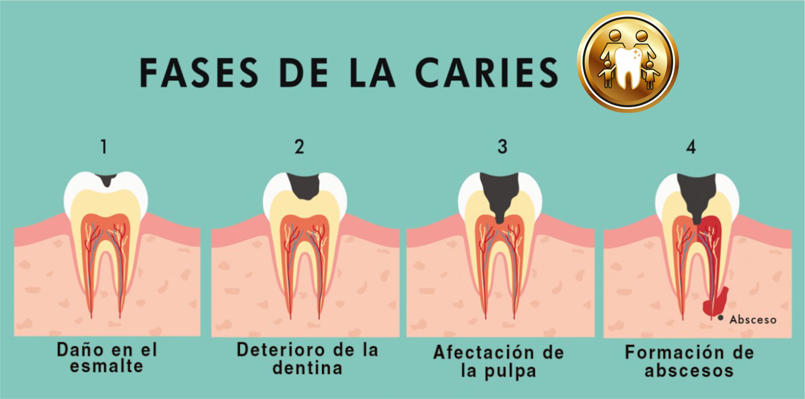 Etapas De La Caries Dental Ilustración De Los Dientes En Diferentes